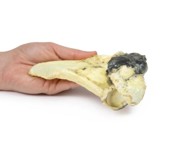Chondrosarcoma of scapula - Australian Physiotherapy Equipment