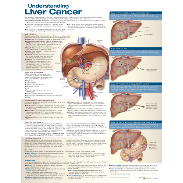 Understanding Liver Cancer Anatomical Chart - Soft Laminate ...